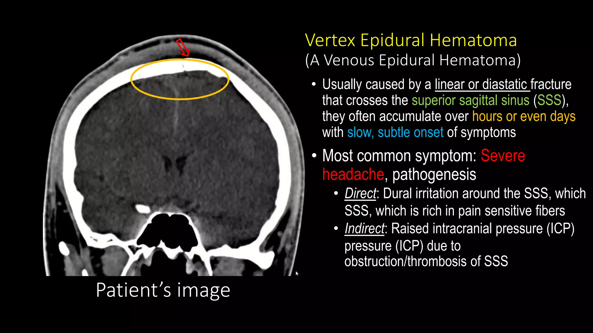 VERTEX EPIDURAL HEMATOMA 1.17.1.42.CT.pptx