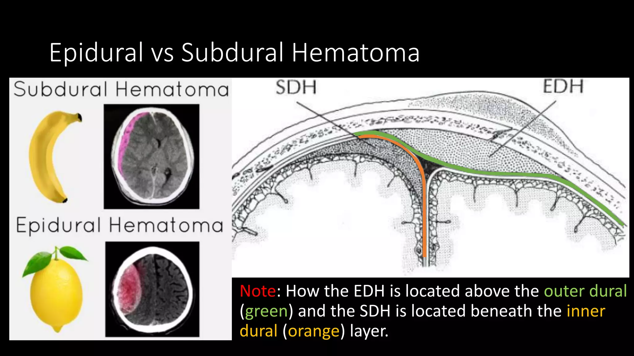 VERTEX EPIDURAL HEMATOMA 1.17.1.42.CT.pptx
