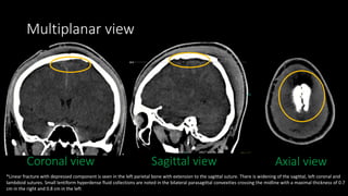VERTEX EPIDURAL HEMATOMA 1.17.1.42.CT.pptx