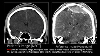 VERTEX EPIDURAL HEMATOMA 1.17.1.42.CT.pptx