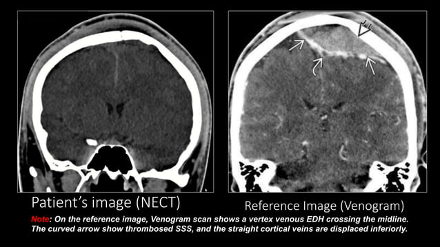VERTEX EPIDURAL HEMATOMA 1.17.1.42.CT.pptx