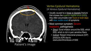 VERTEX EPIDURAL HEMATOMA 1.17.1.42.CT.pptx