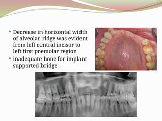 Vertical and horizontal ridge augmentation in anterior maxilla | PPTX