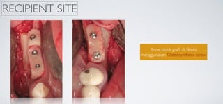 Vertical augmentation | PDF