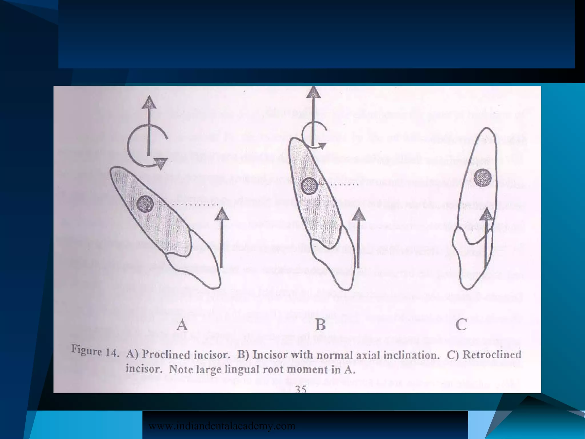 Vertical control in straight wire technique , intrusion mechanics | PPT