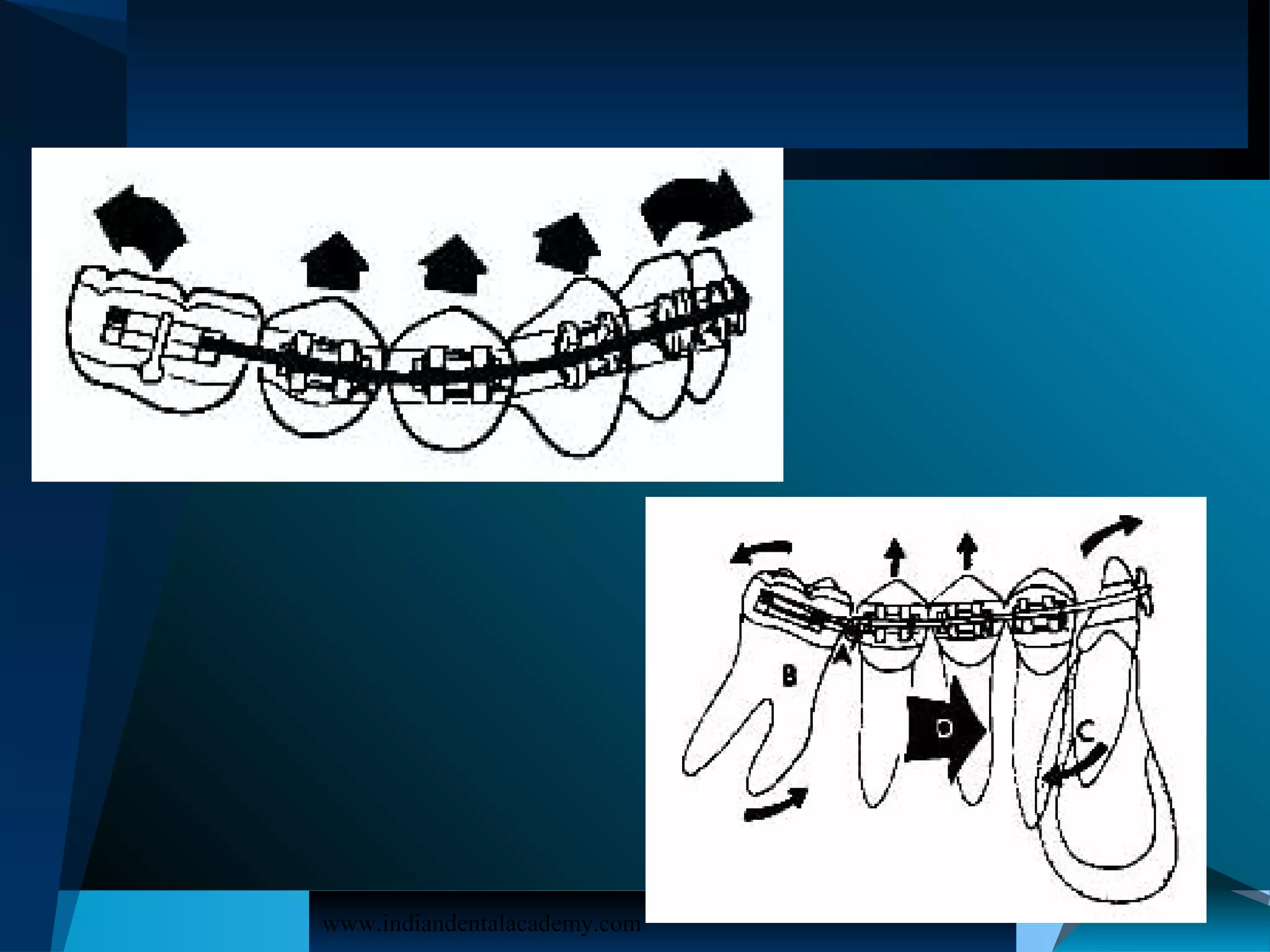 Vertical control in straight wire technique , intrusion mechanics | PPT