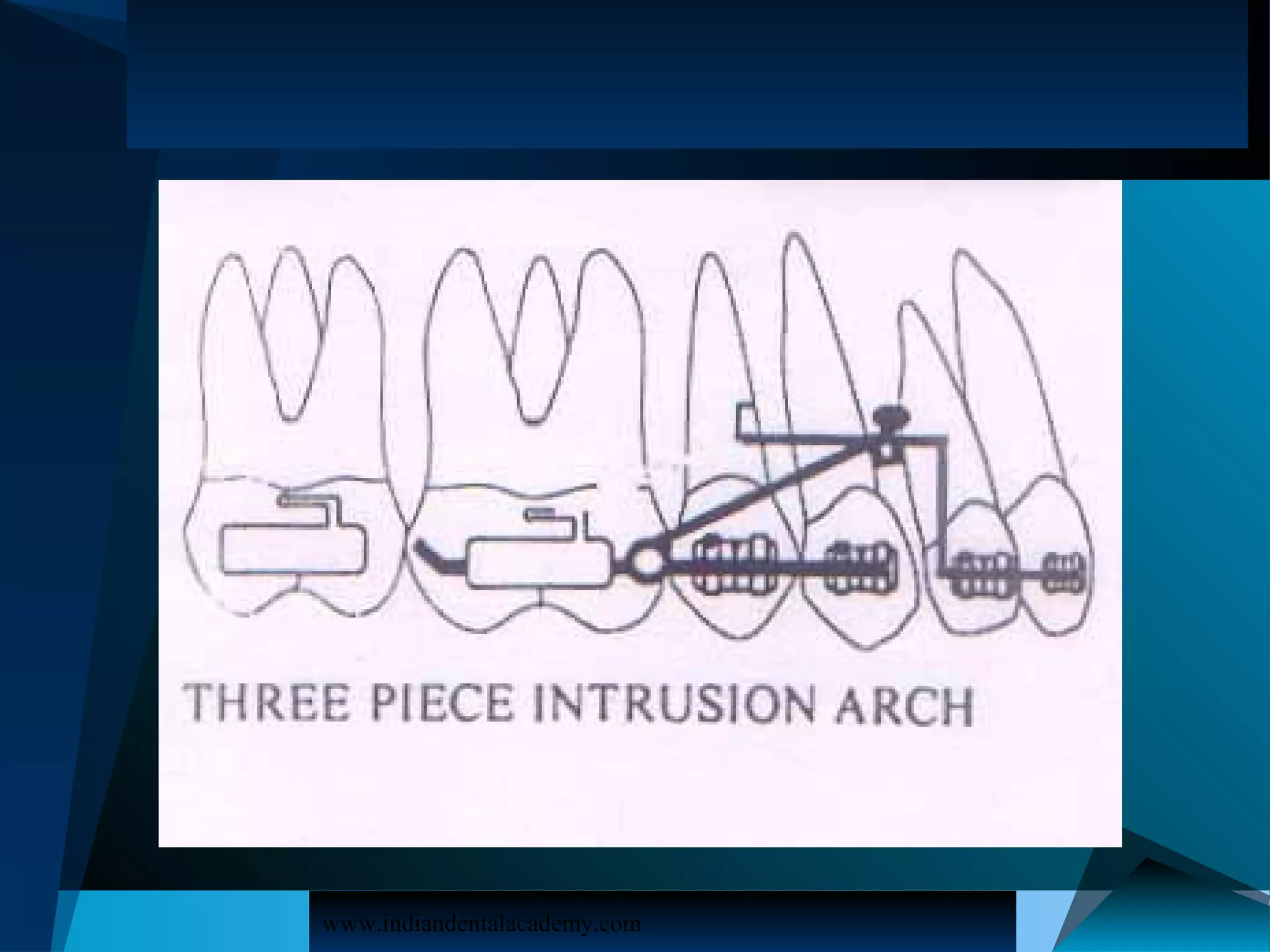Vertical control in straight wire technique , intrusion mechanics | PPT