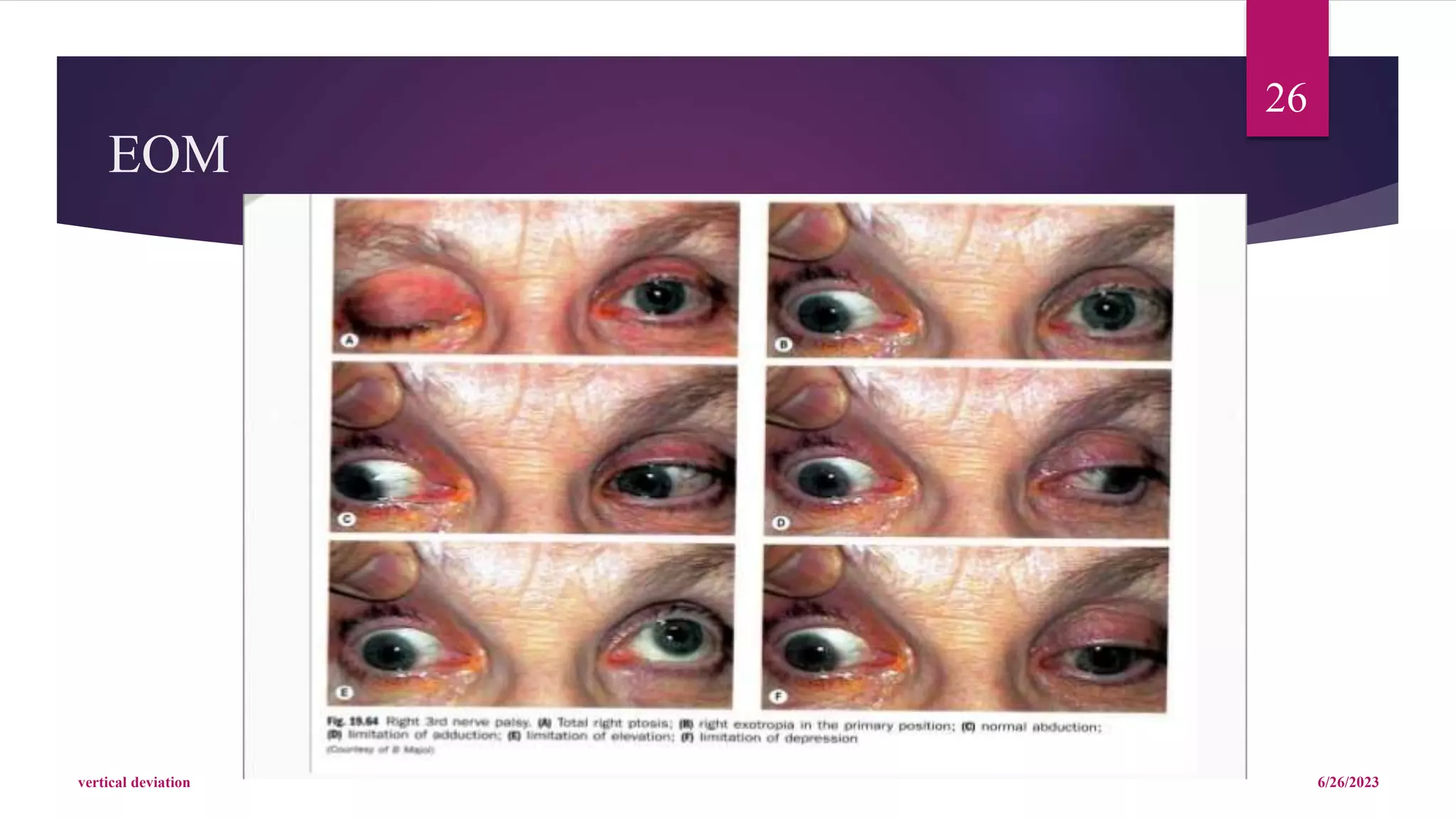 Vertical Deviation.pptx