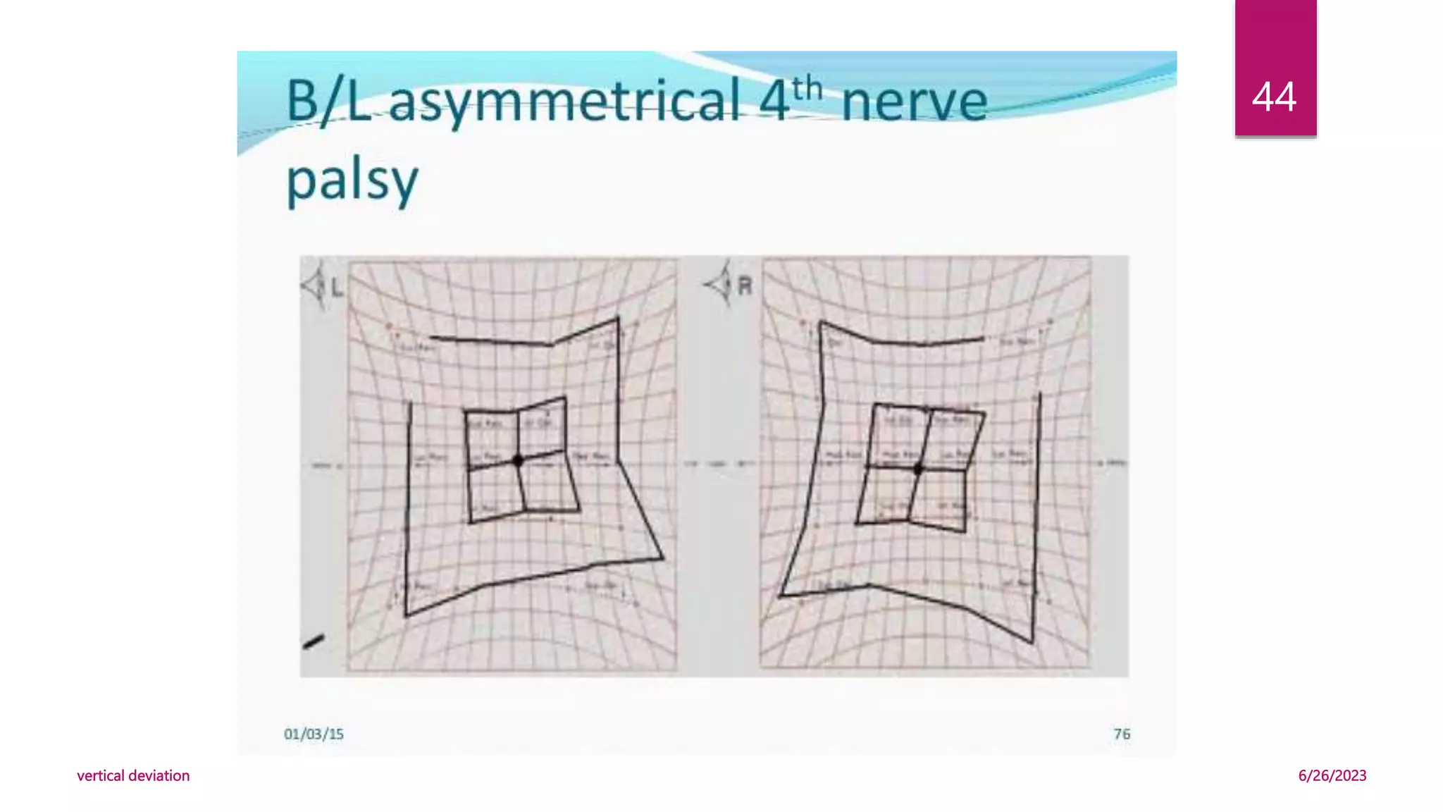 Vertical Deviation.pptx
