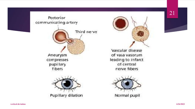 Vertical Deviation.pptx