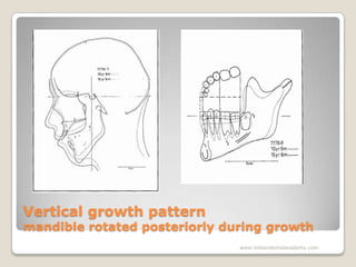 Vertical malocclusions /certified fixed orthodontic courses by Indian ...