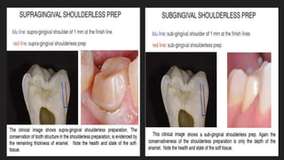 Vertical preparation | PPT