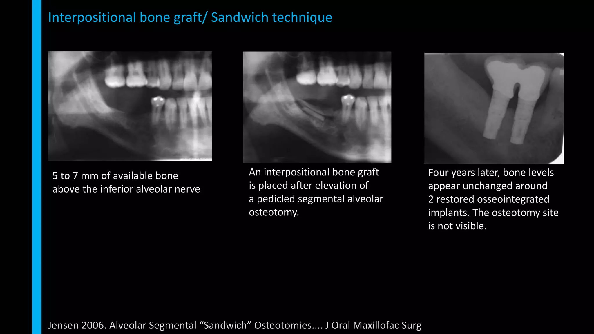 Vertical ridge augmentation | PPTX