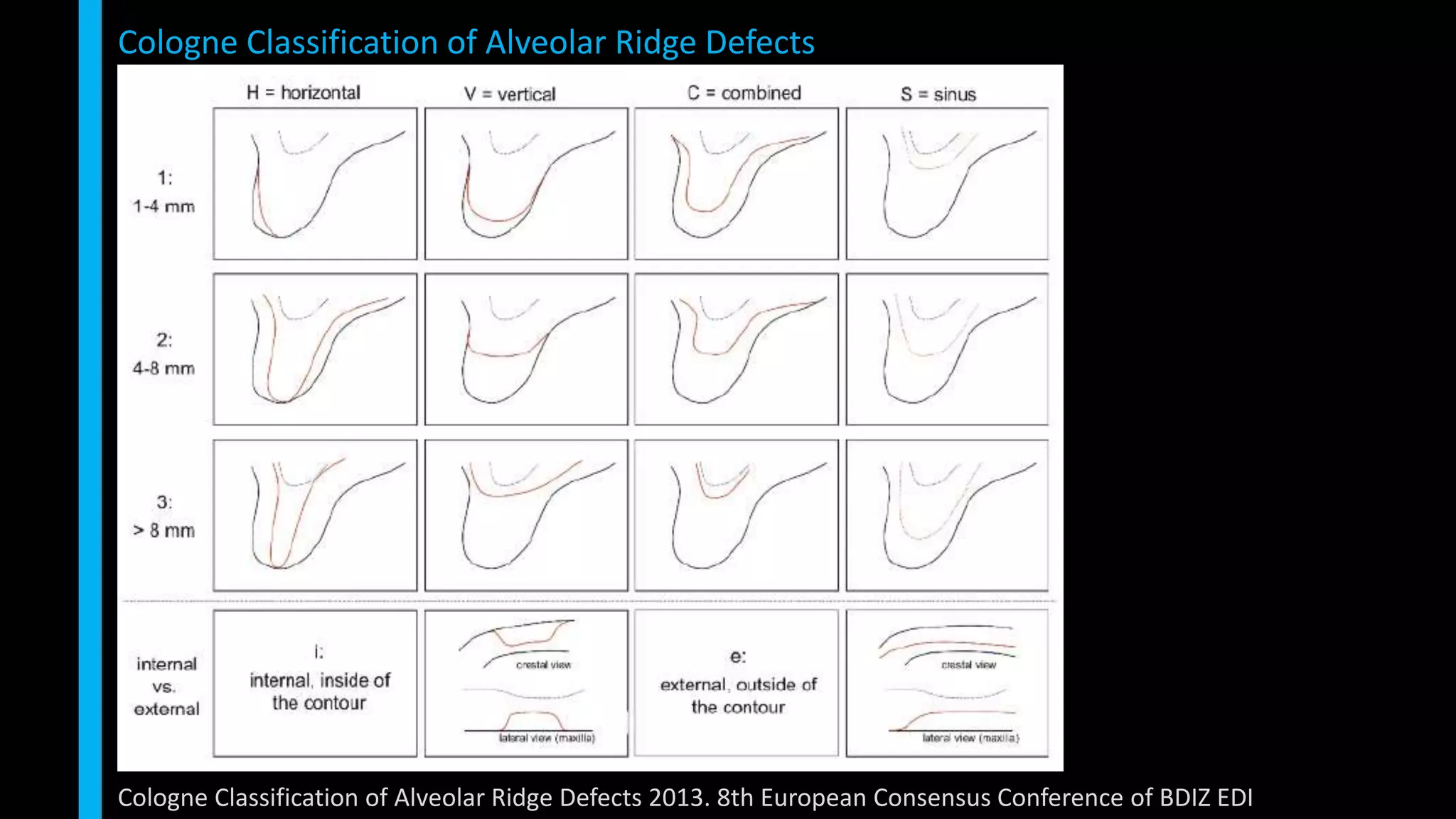 Vertical ridge augmentation | PPTX