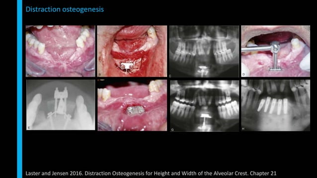 Vertical ridge augmentation | PPTX | Bone and Joint Conditions ...