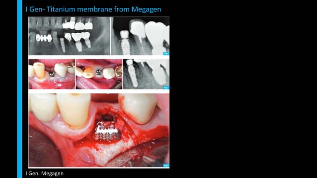 Vertical ridge augmentation | PPTX | Bone and Joint Conditions ...