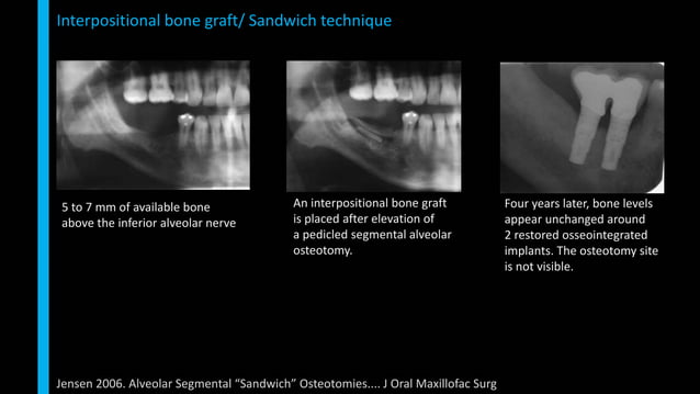 Vertical ridge augmentation | PPTX | Bone and Joint Conditions ...
