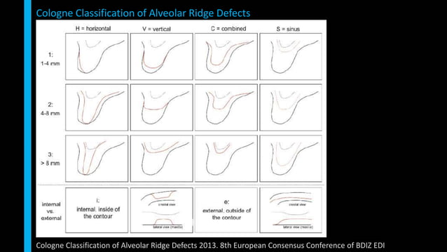 Vertical ridge augmentation | PPTX | Bone and Joint Conditions ...