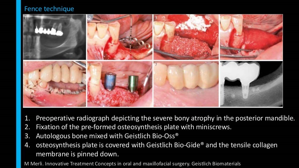 Vertical ridge augmentation