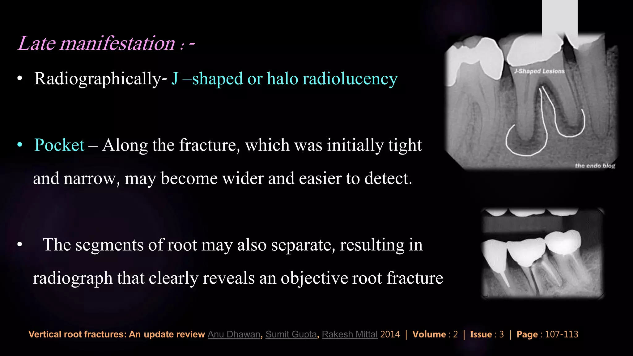 Vertical root fracture | PPTX