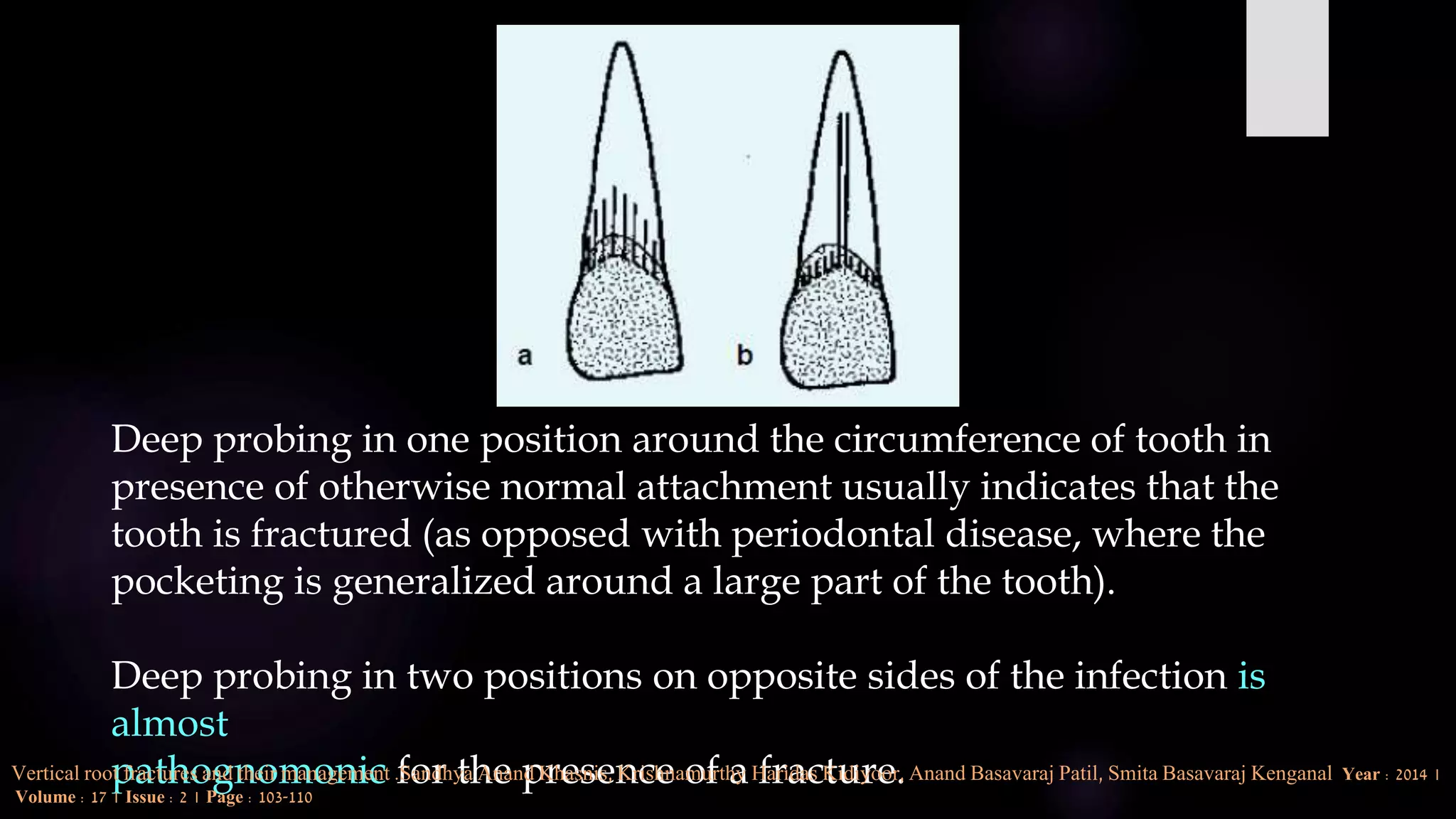 Vertical root fracture | PPTX
