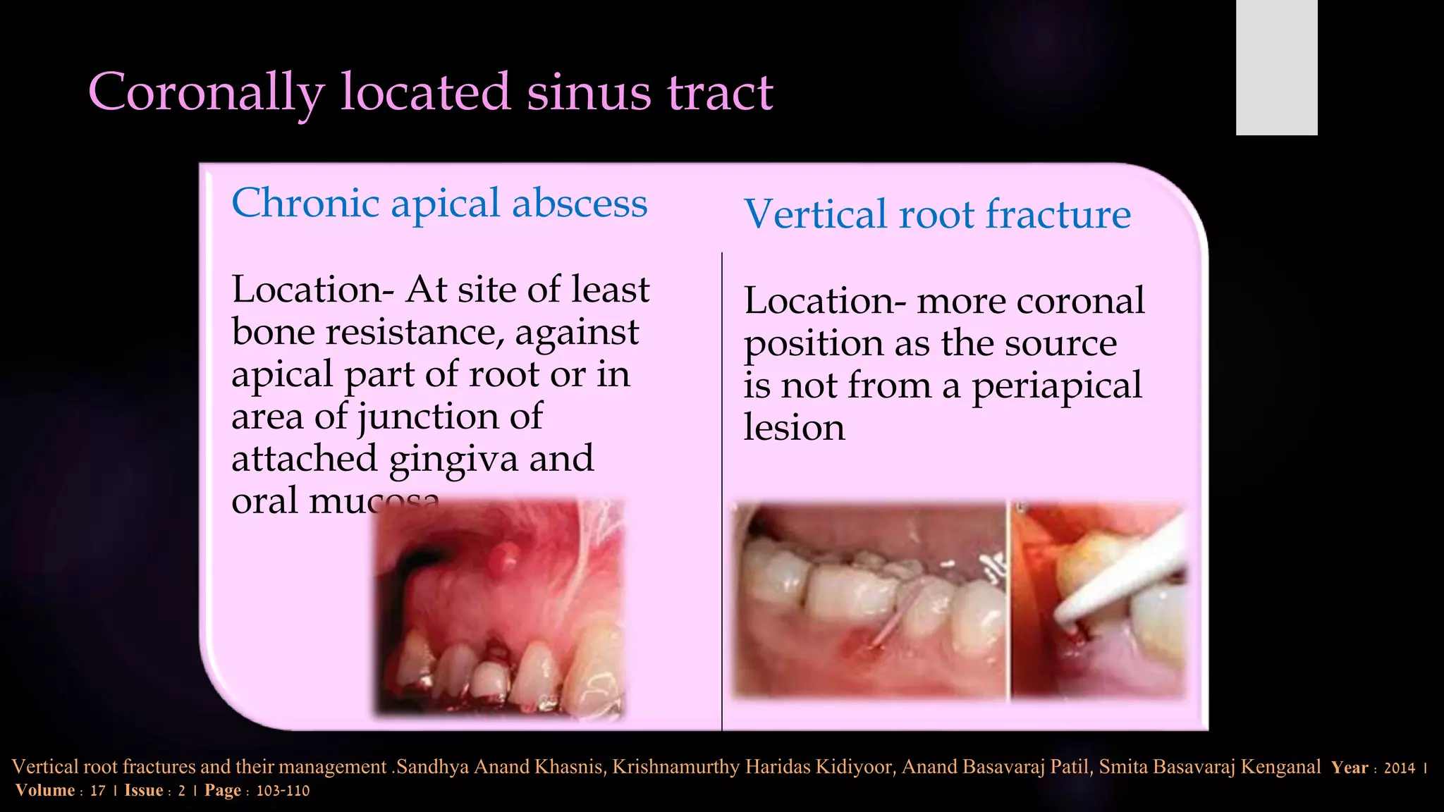 Vertical root fracture | PPTX | Dental Health | Diseases and Conditions