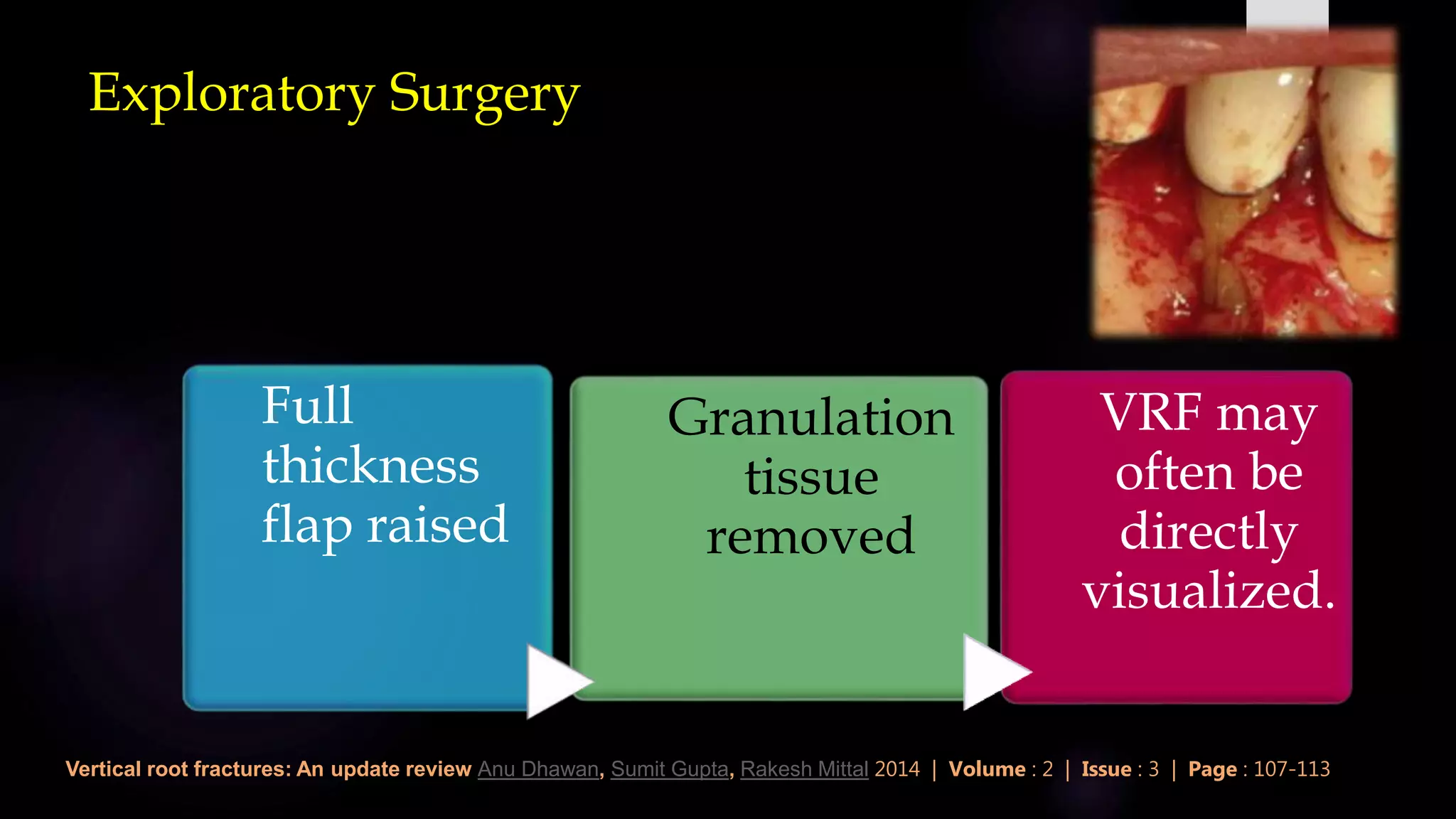 Vertical root fracture | PPTX