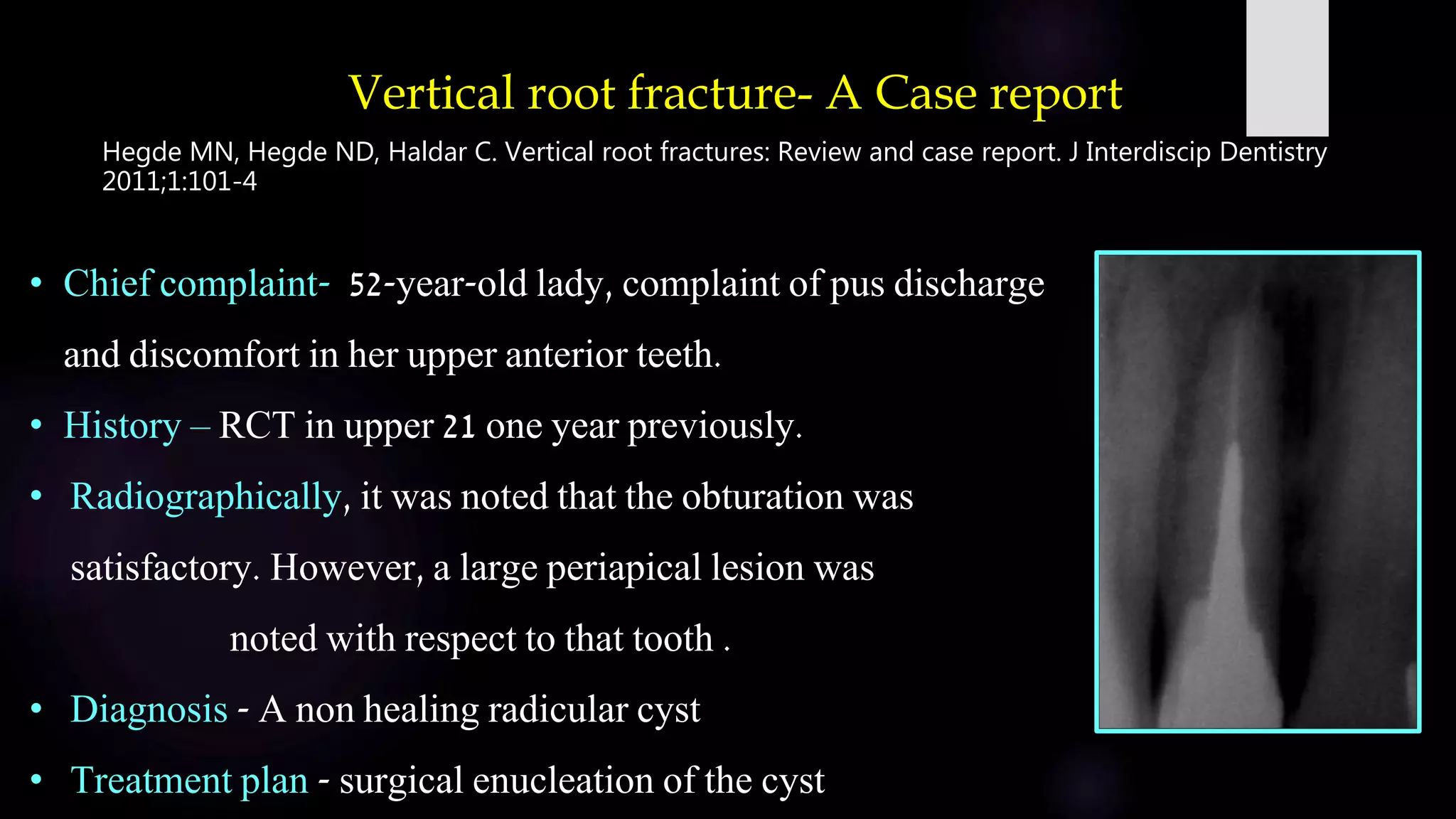 Vertical root fracture | PPTX | Dental Health | Diseases and Conditions