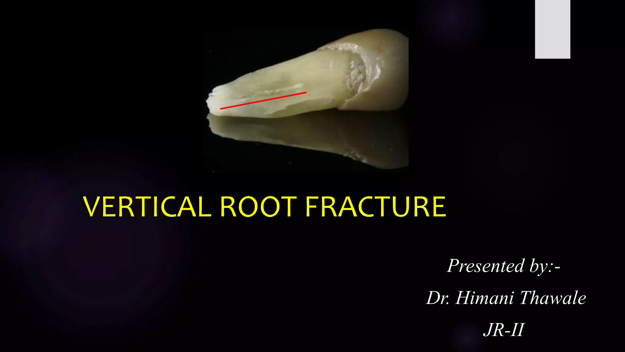 Vertical root fracture | PPT