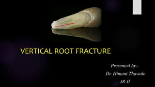 Vertical root fracture | PPTX