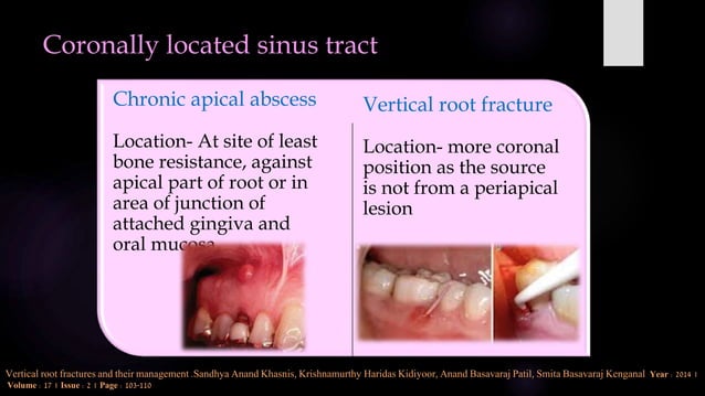 Vertical root fracture | PPTX | Dental Health | Diseases and Conditions