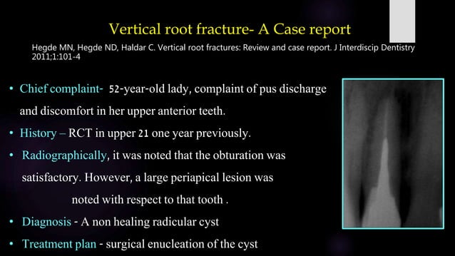 Vertical root fracture | PPTX | Dental Health | Diseases and Conditions