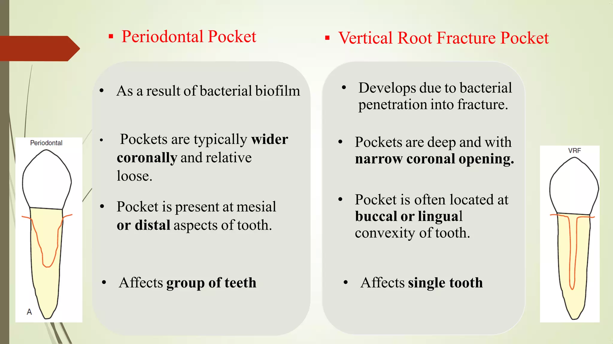 VERTICAL ROOT FRACTURE !.pdf