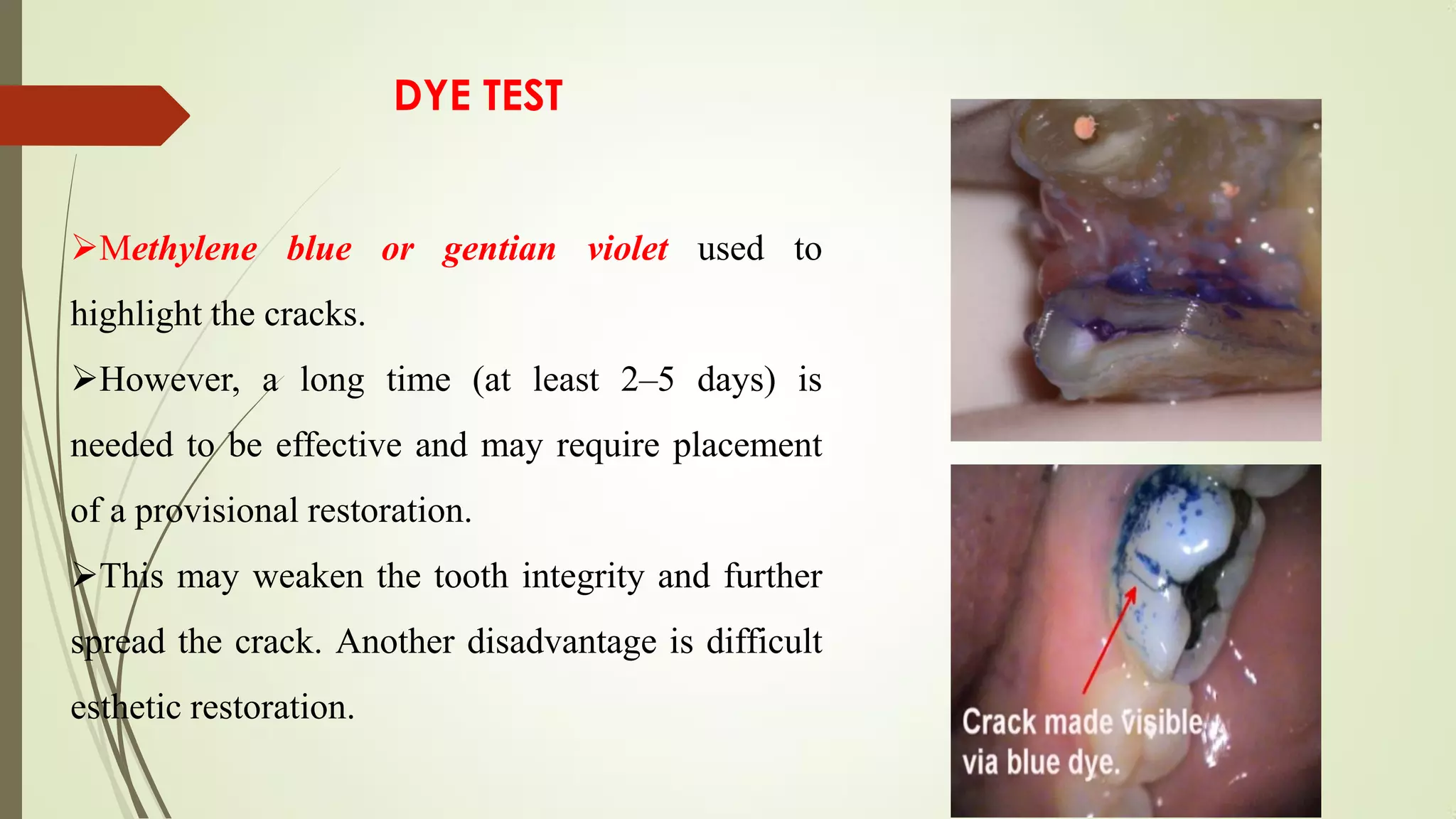 VERTICAL ROOT FRACTURE !.pdf