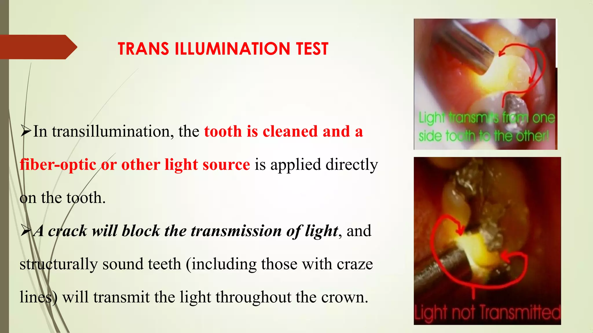 VERTICAL ROOT FRACTURE !.pdf