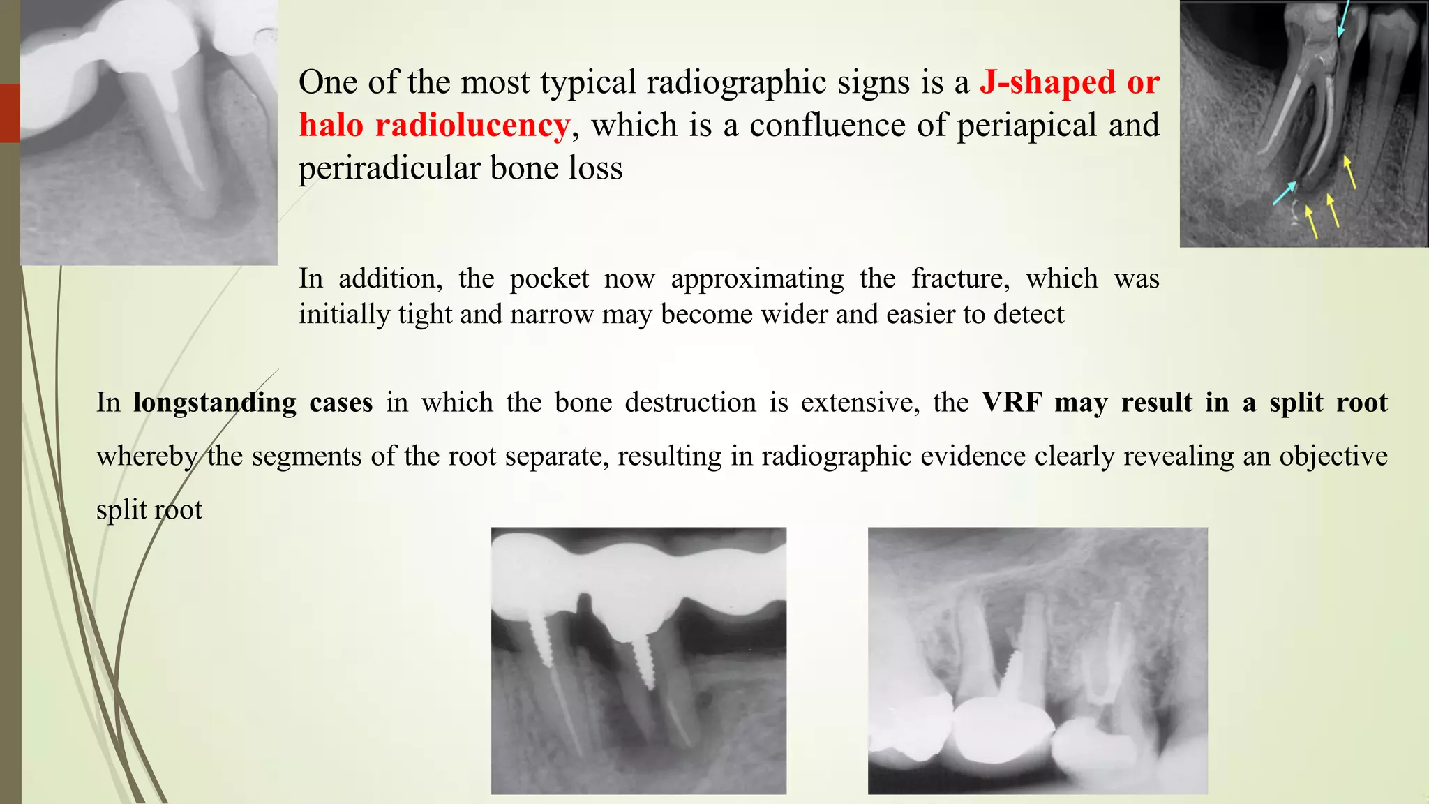 VERTICAL ROOT FRACTURE !.pdf