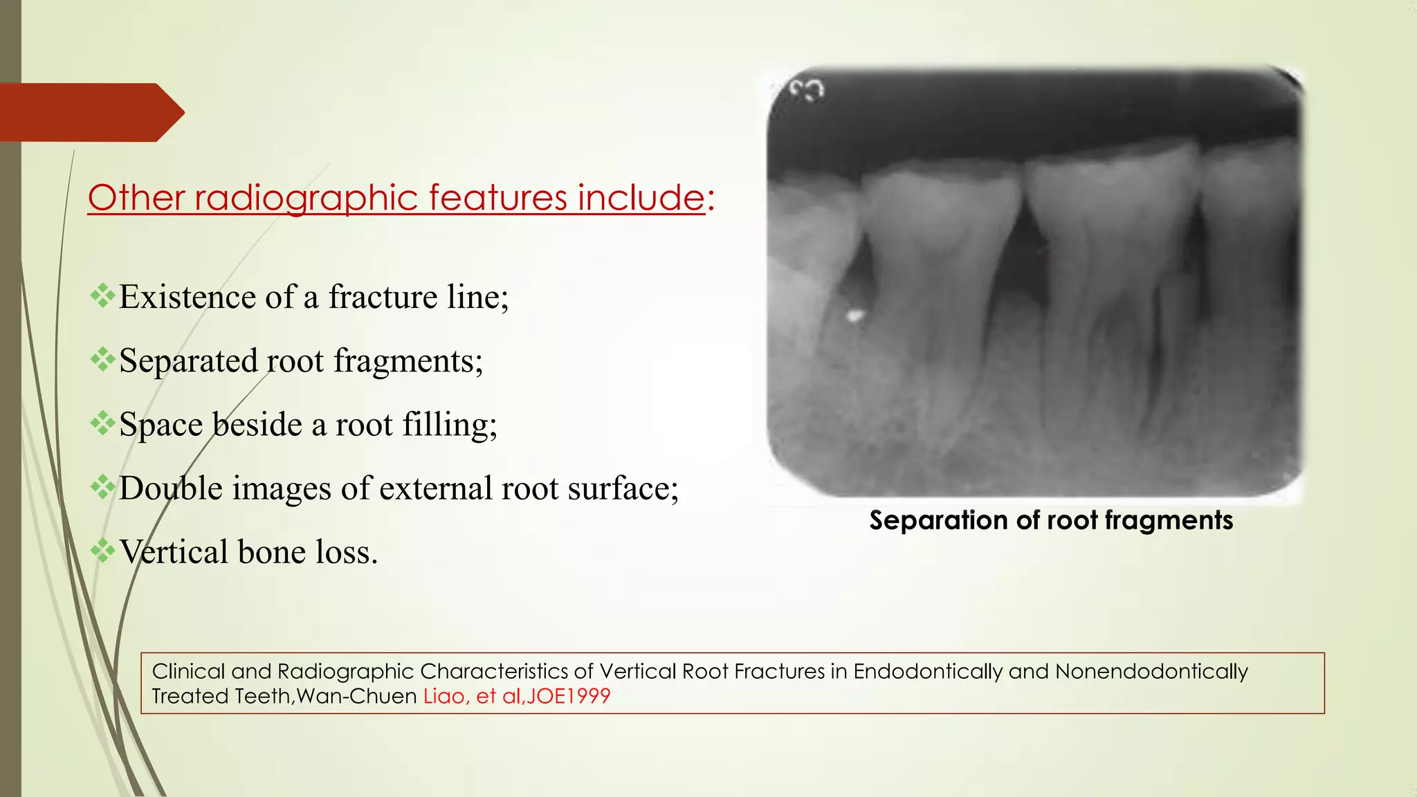 VERTICAL ROOT FRACTURE !.pdf