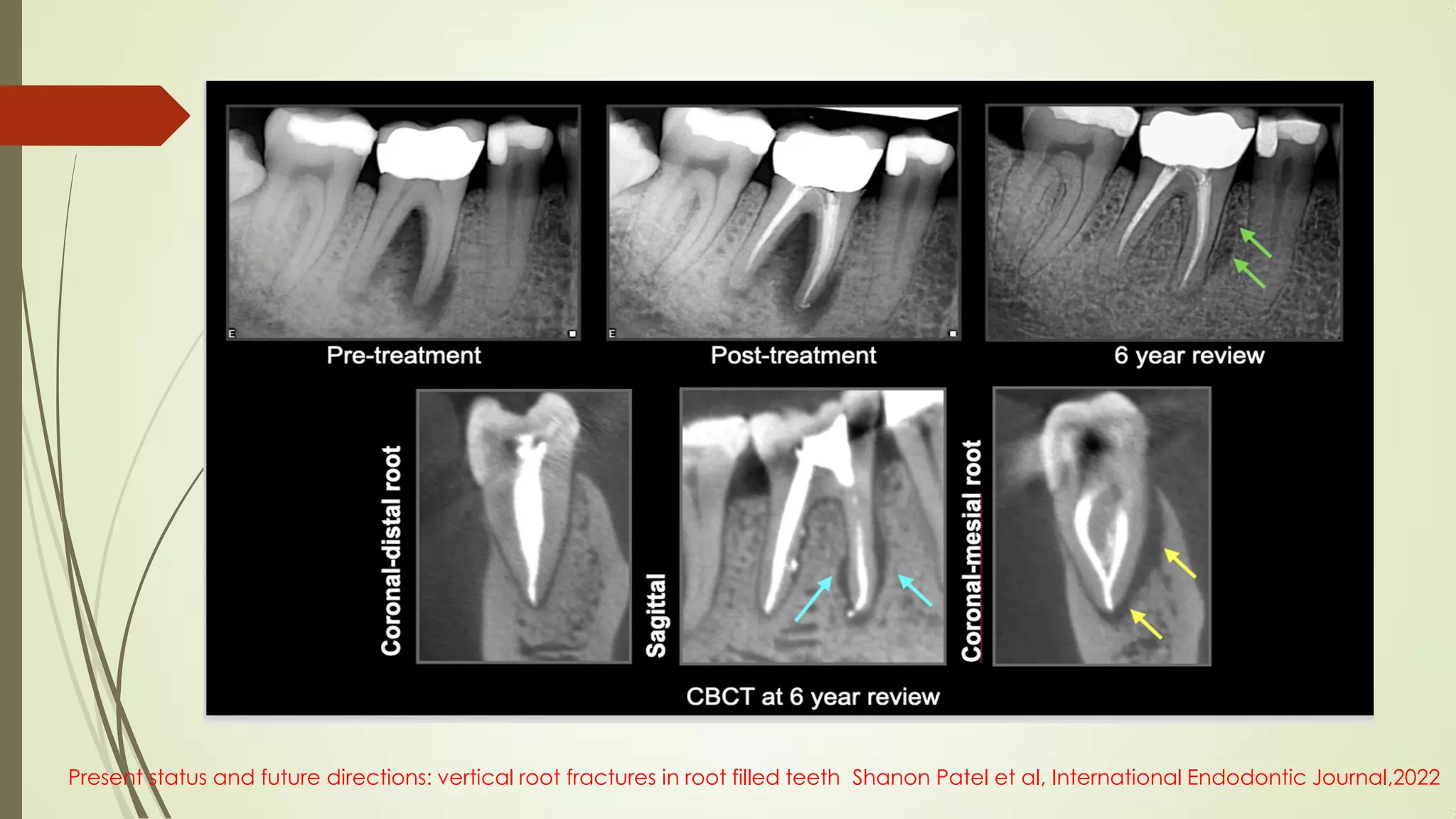 VERTICAL ROOT FRACTURE !.pdf