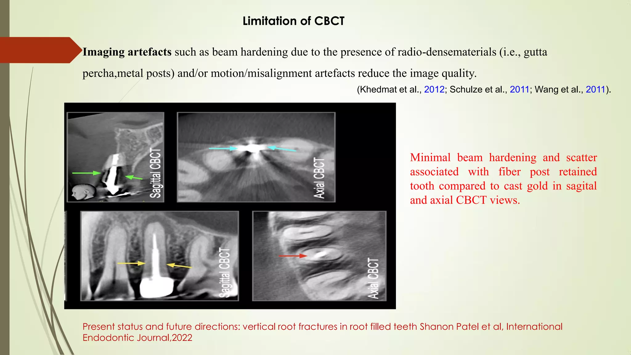 VERTICAL ROOT FRACTURE !.pdf