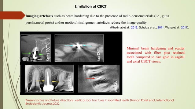 VERTICAL ROOT FRACTURE !.pdf