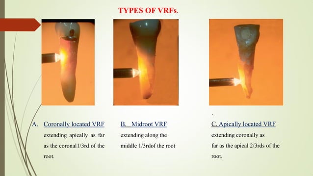 VERTICAL ROOT FRACTURE !.pdf