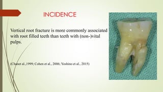 VERTICAL ROOT FRACTURE !.pdf