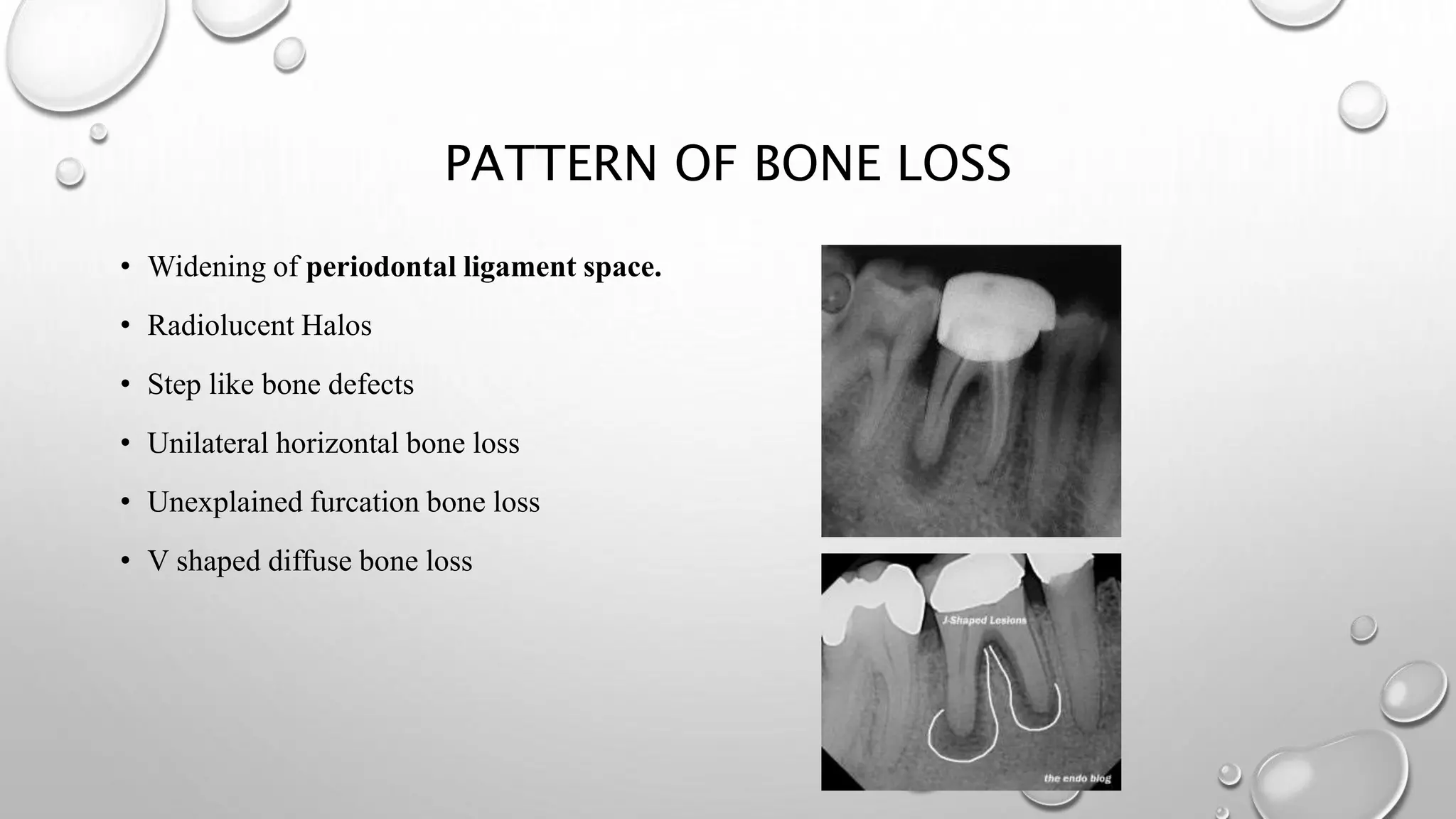Vertical root fractures | PPTX