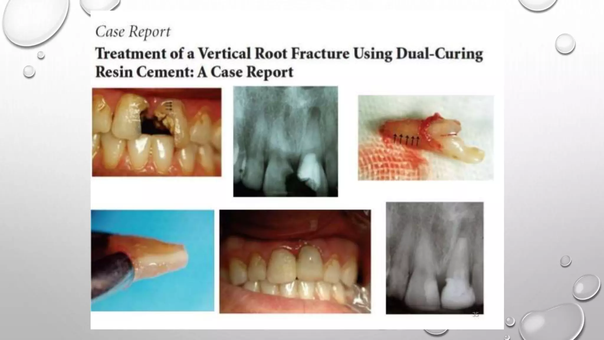 Vertical root fractures | PPTX