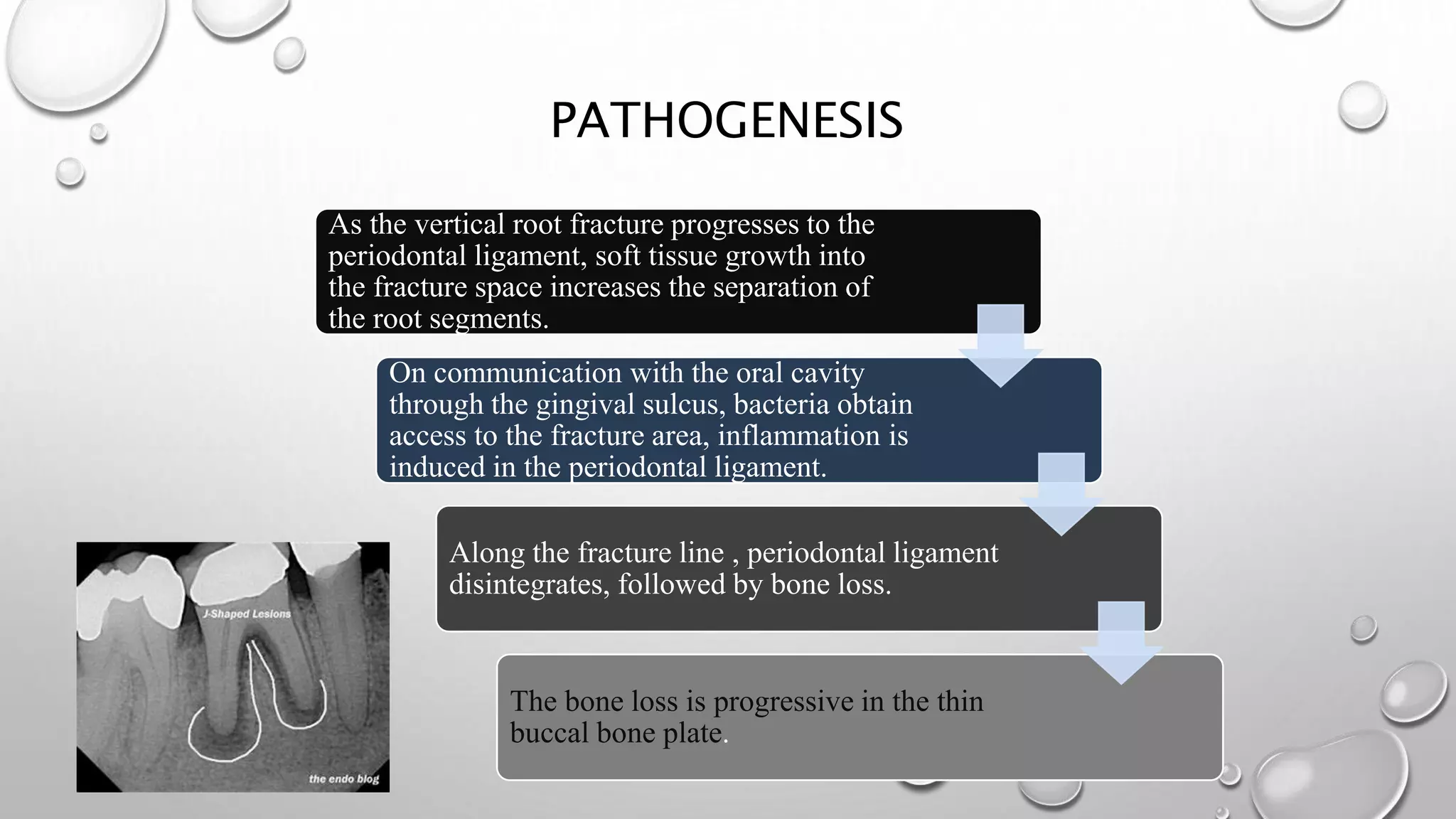 Vertical root fractures | PPTX