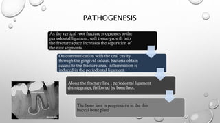 Vertical root fractures | PPTX