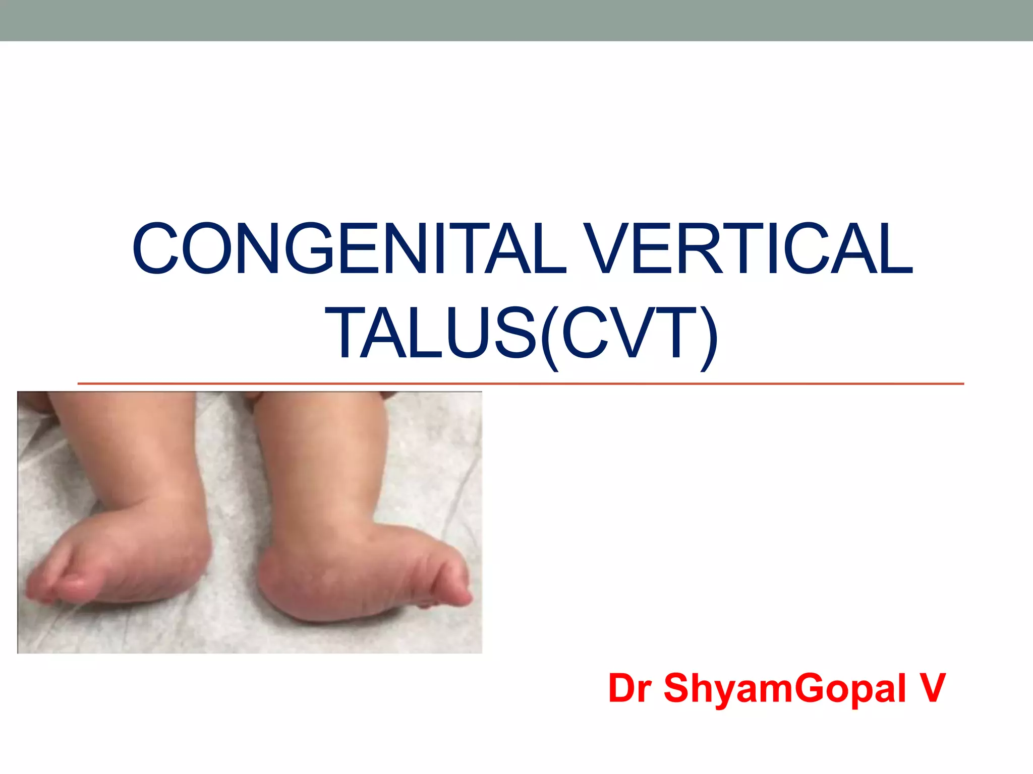 Vertical talus | PPTX