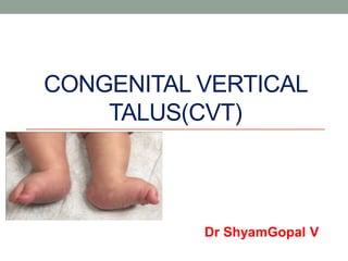 Vertical talus | PPTX