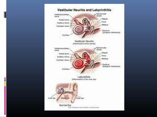 meniere's disease (Vertigo) and labyrinthitis | PPT