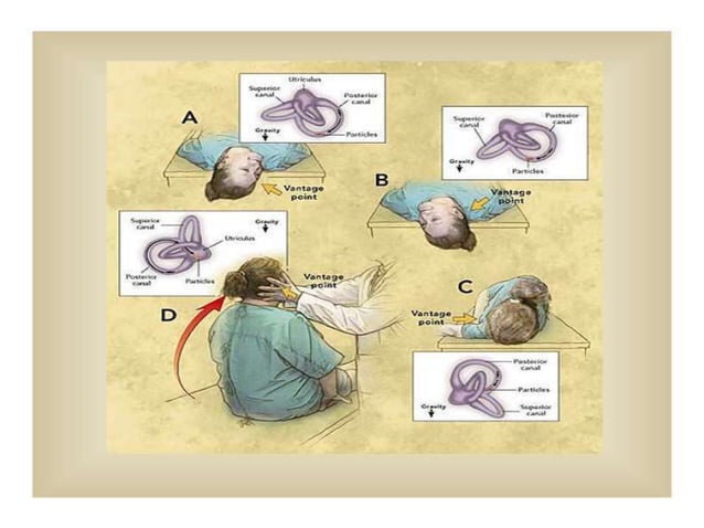 Vertigo and peripheral vestibular disorders | PPTX | Brain and Nervous ...